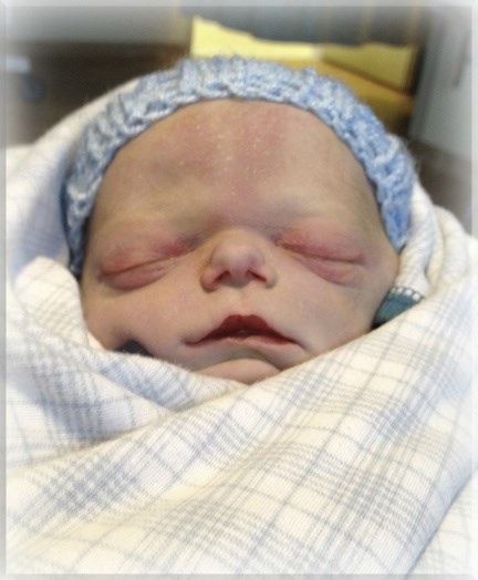 Forceps Delivery Scars