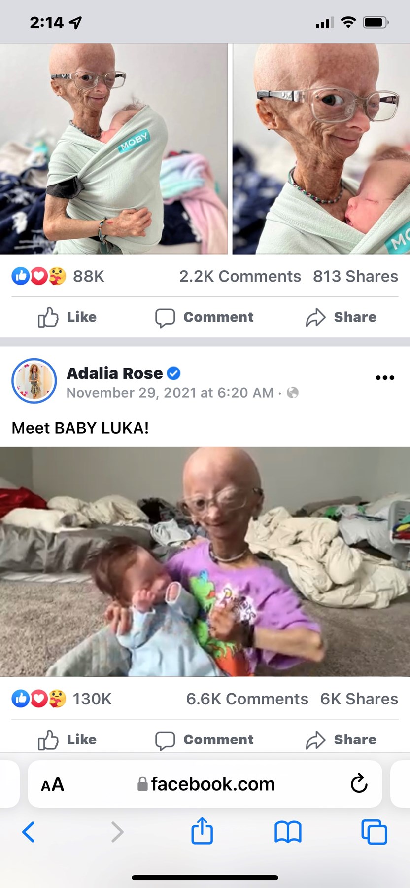 Progeria Adalia Rose Baby
